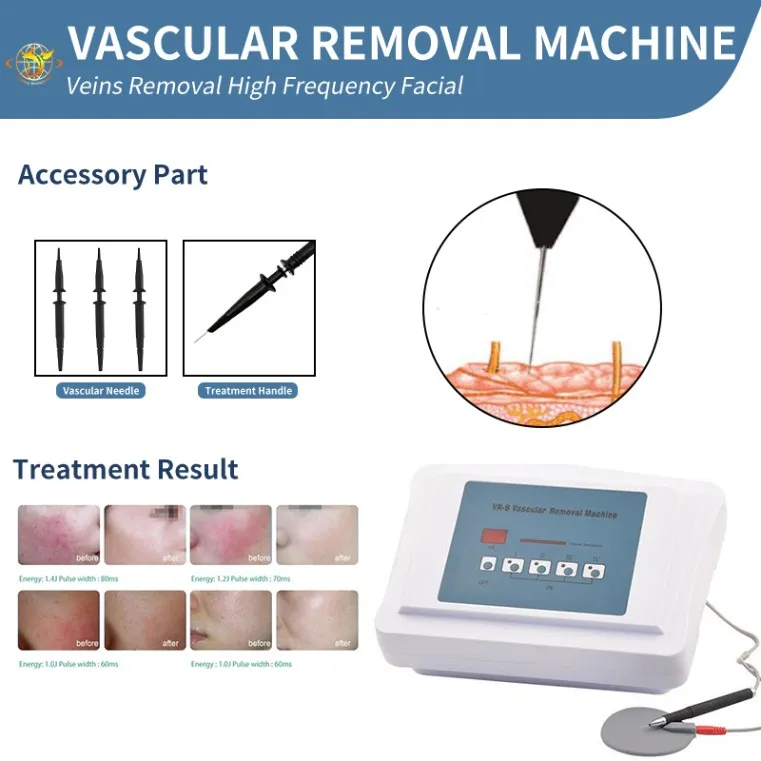 Spider Vein Removal Machine, High Frequency RF, 15W, Broken Capillaries ...