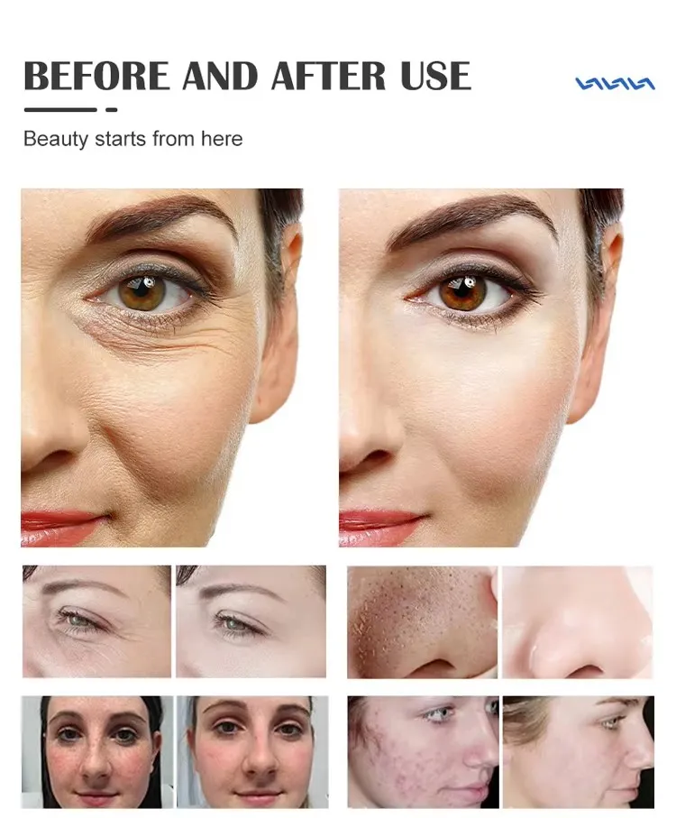 Upgrade H2o2 Beauty Diamond Dermabrasion 17 In 1 Facial Exfoliating ...