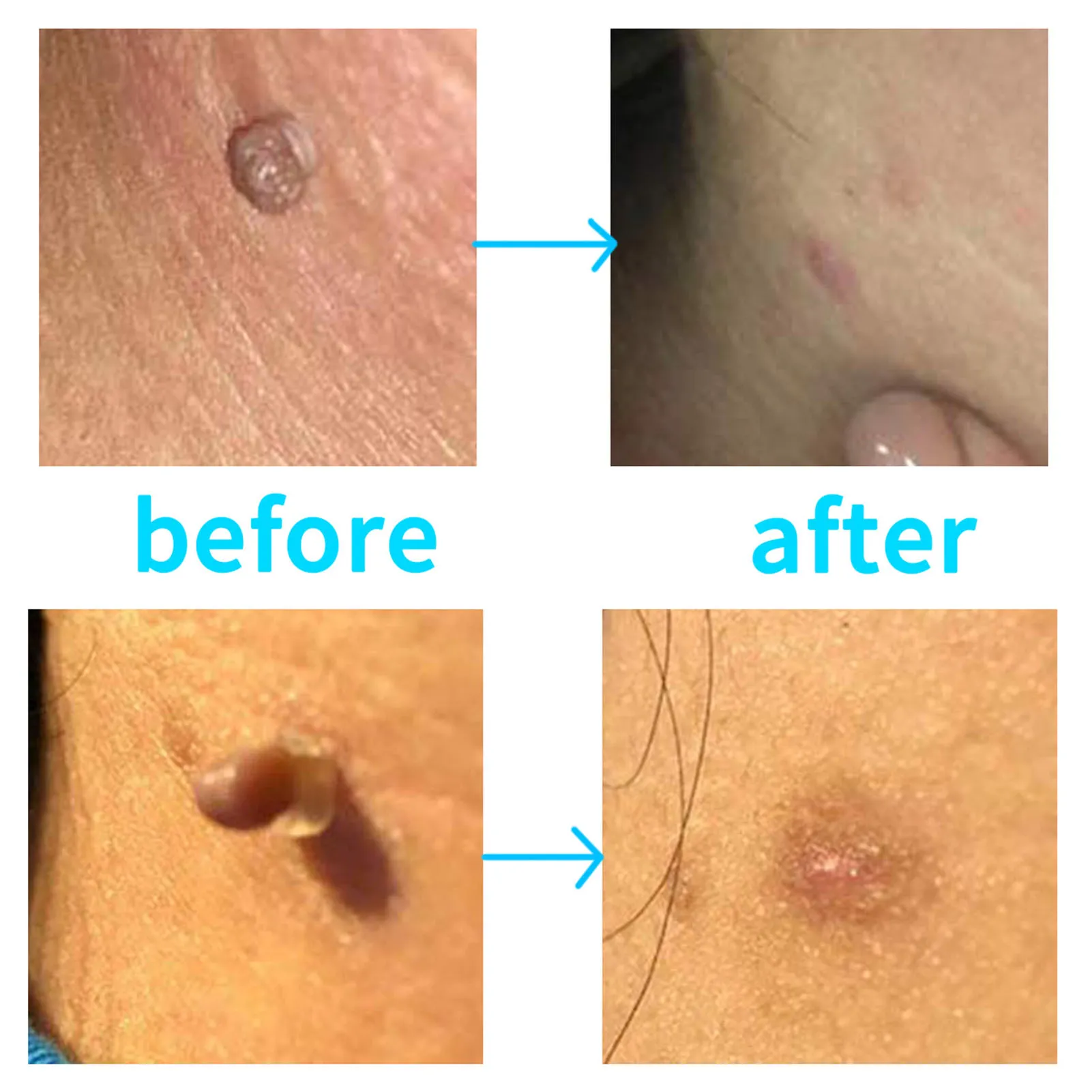 Skin Tag Remover Kit - All-Natural Skin Tag Removal System for Face ...