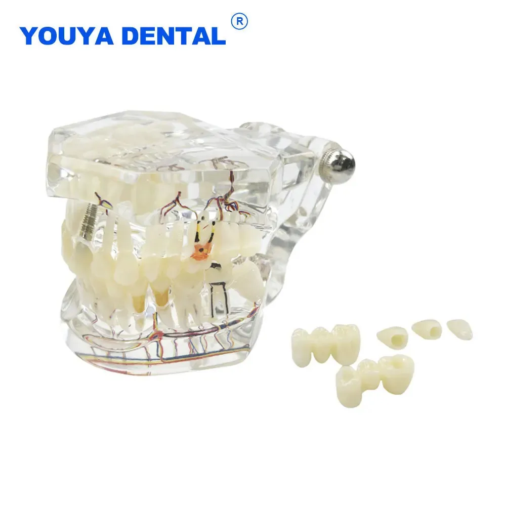 Pathological Dental Implant Disease Teeth Model X For Neural Repair And ...