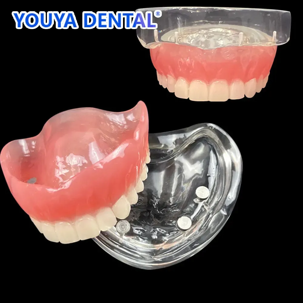 Anatomical Teeth Models: Upper Overdenture Model With Magnetic ...