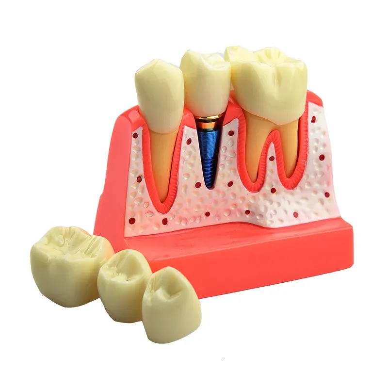 Dental Model Dental Implant Bridge Crown Porcelain Restoration Teaching ...