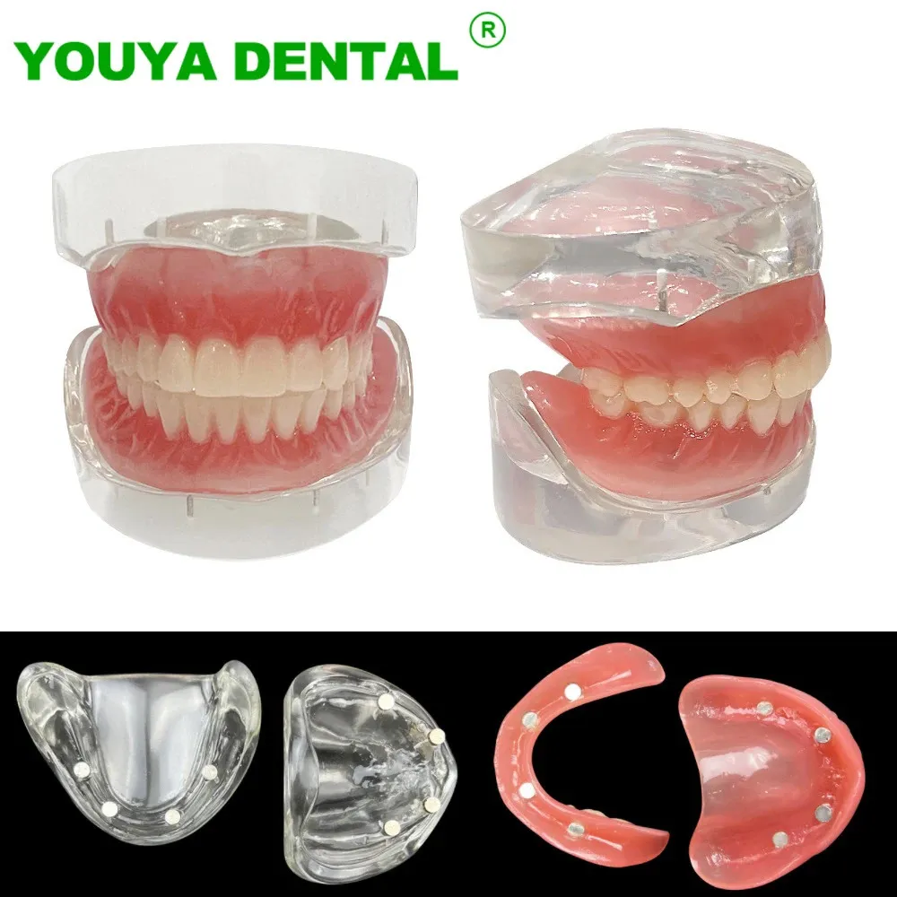 Dental Overdenture Transparent Teeth Braces Model With Removable Bridge ...