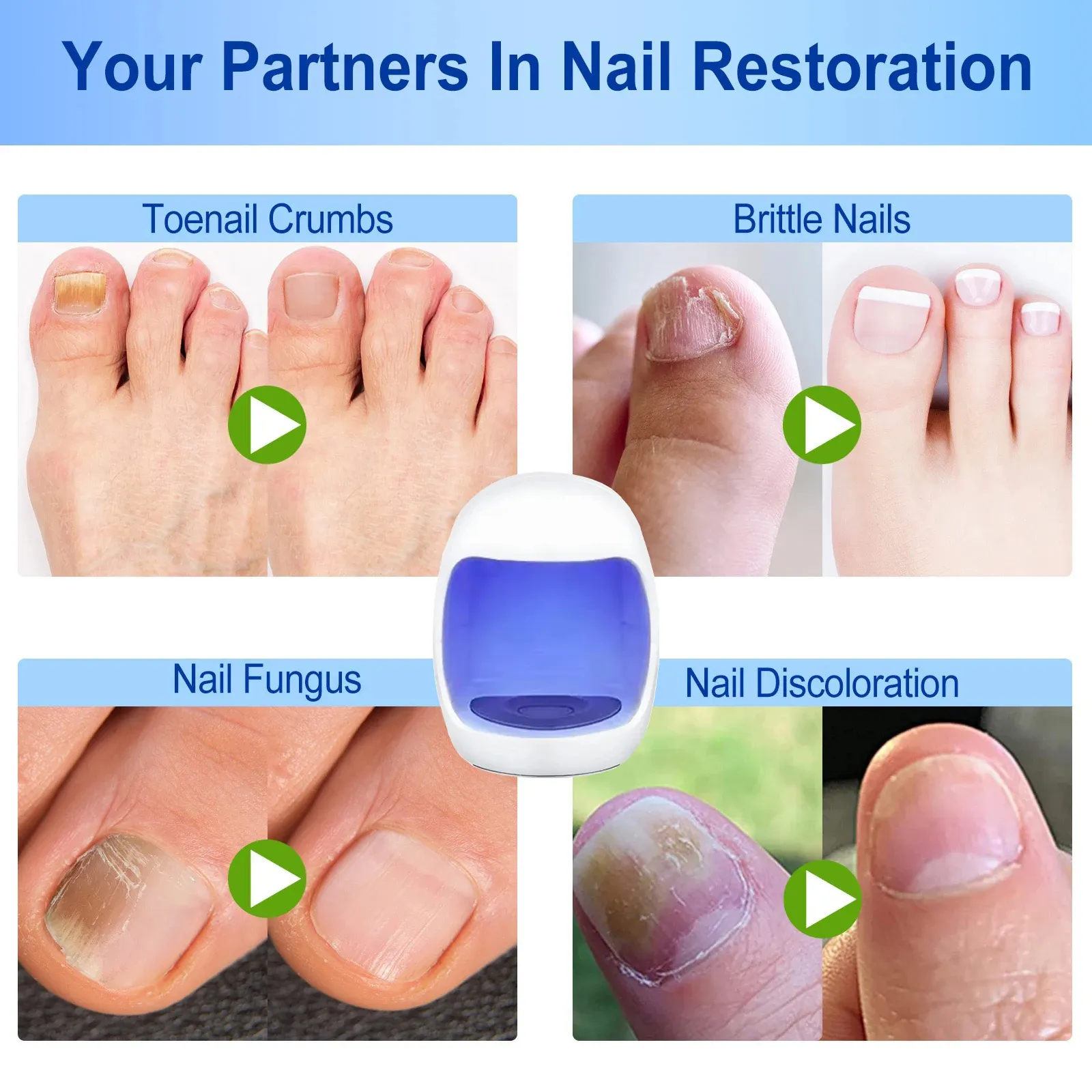 Advanced Fungal Nail Treatment Device: Restore Healthy Nails, Combat ...