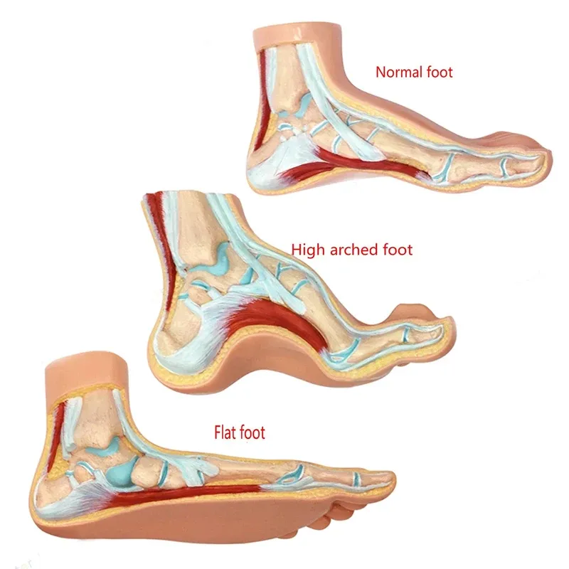 3D Printed Anatomy Foot Joint Model - High/Normal Arch, Claw Foot, for ...