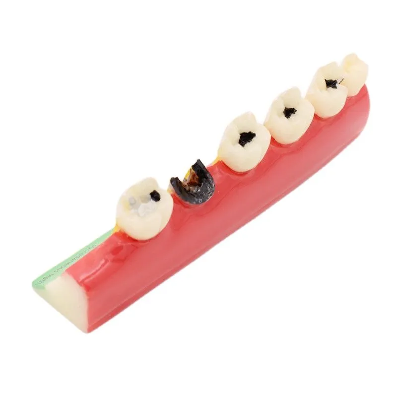 Anatomical Teeth Models: Periodontal Disease & Caries Breakdown Model ...
