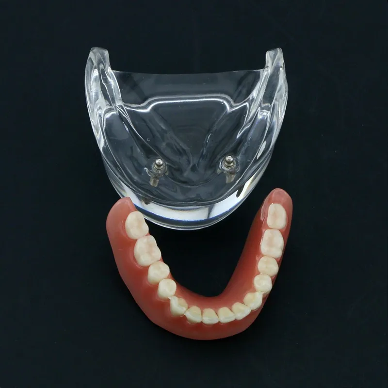 Dental strategic instruction model with Implant Overdenture and ...