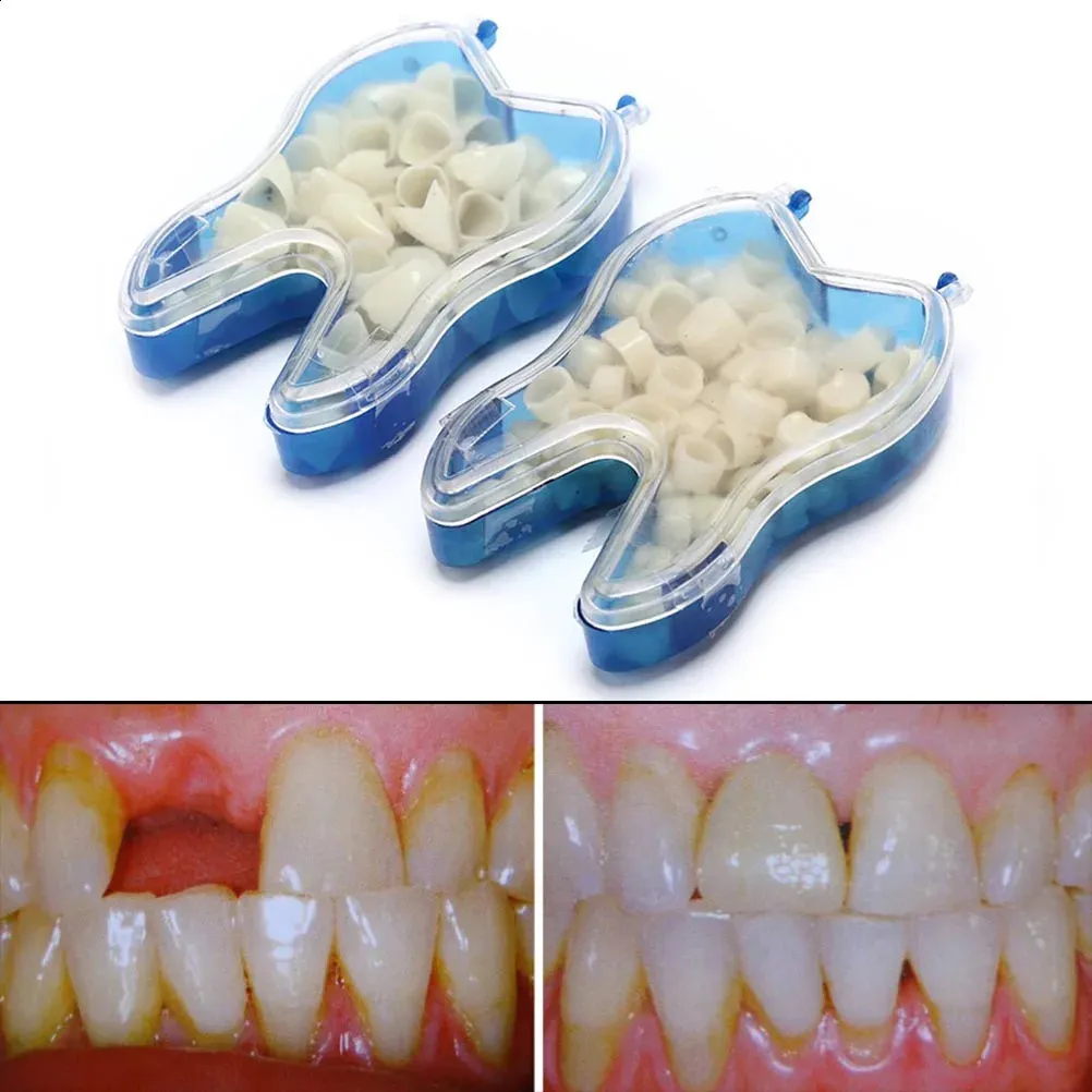 Dental Resin Temporary Crowns & Fake Teeth - Anteriors & Posteriors ...