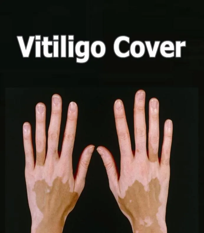 Vitiligo Concealer Liquid Pen Waterproof Vitiligo Patches Natural Hide ...