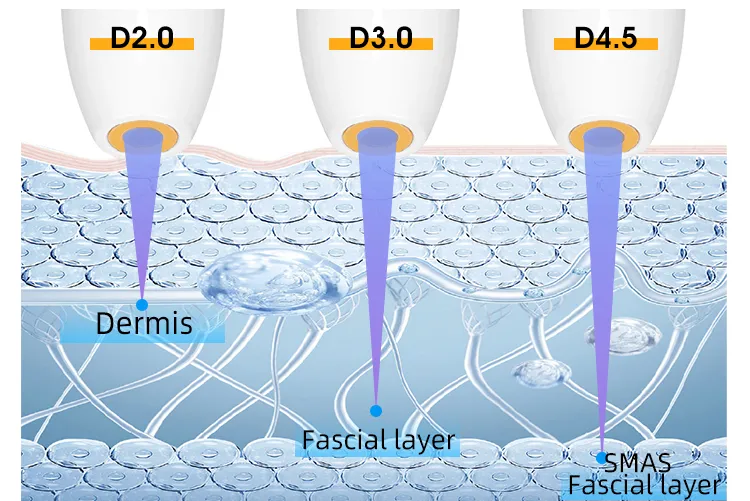 High Intensity Focused Ultrasound Skin Tightening Machine with 5 ...