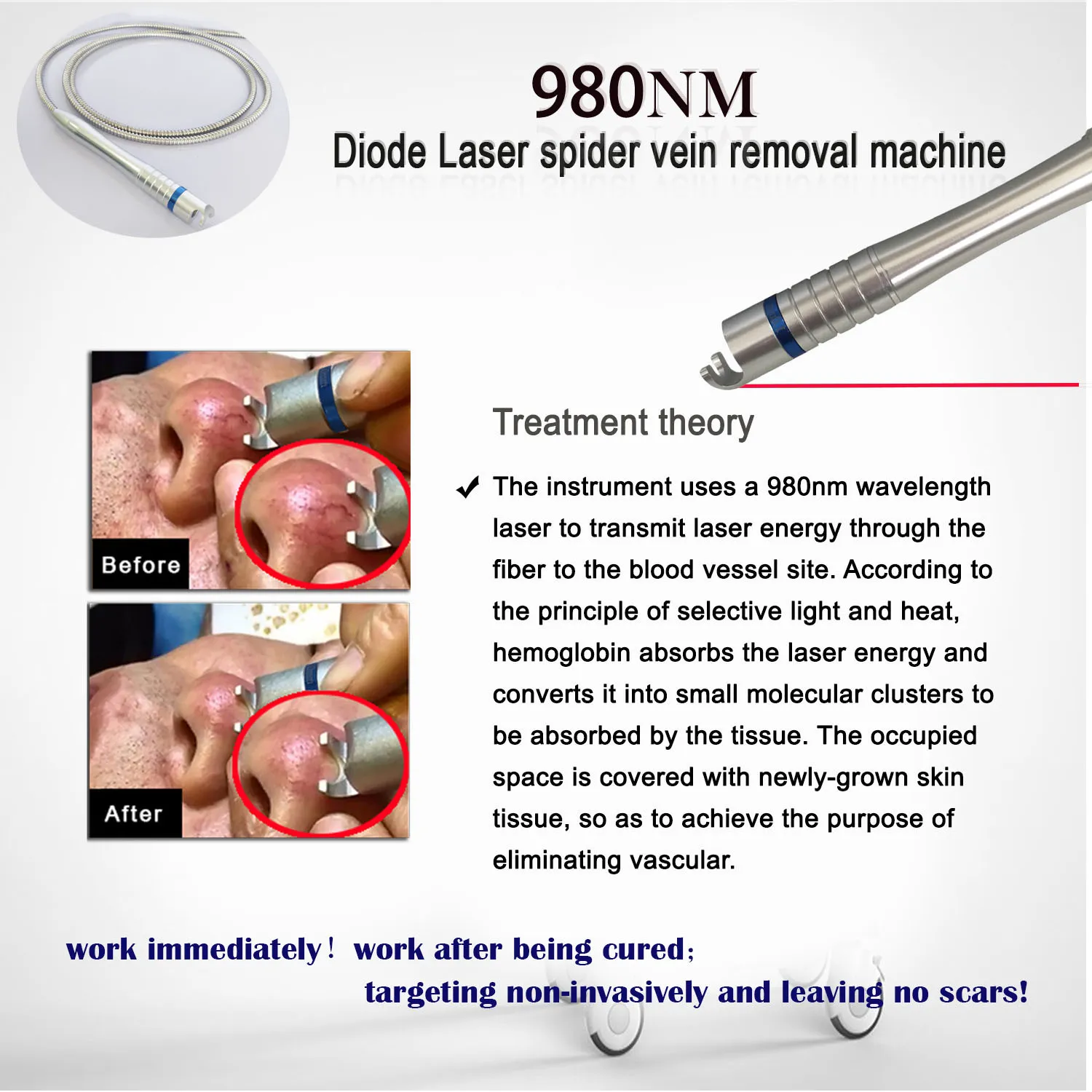 New 980nm Diode Laser Device for Vascular Removal, Nail Fungus ...