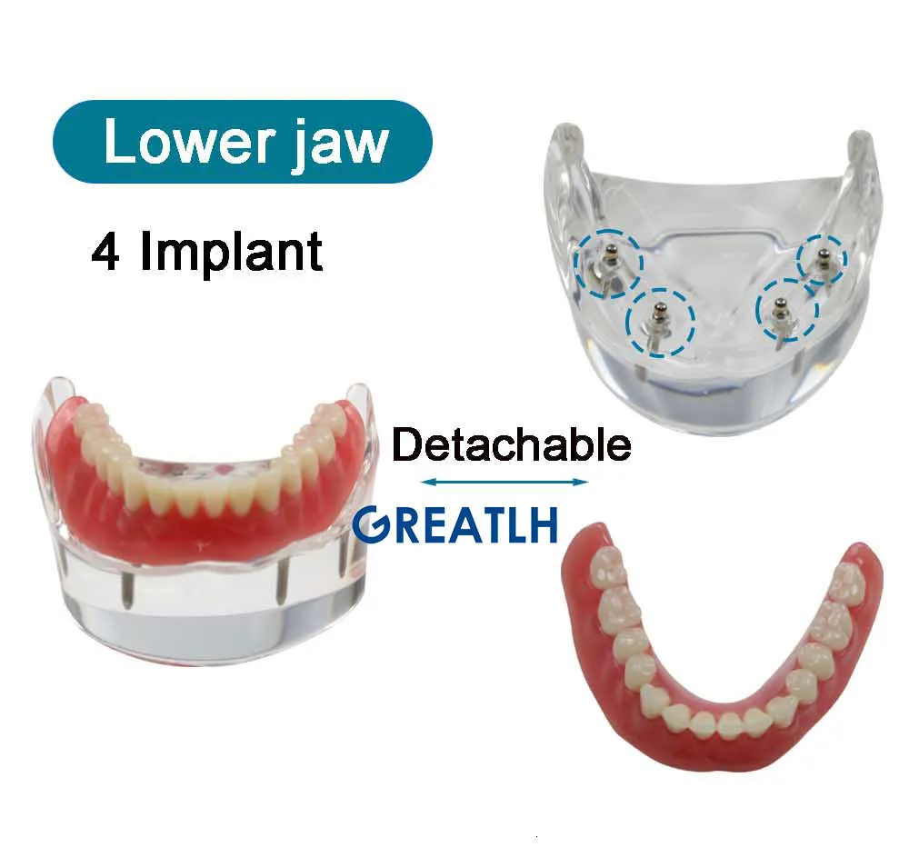 DHgate.com:Superior Dental Implant Teeth Model: Realistic Overdenture ...
