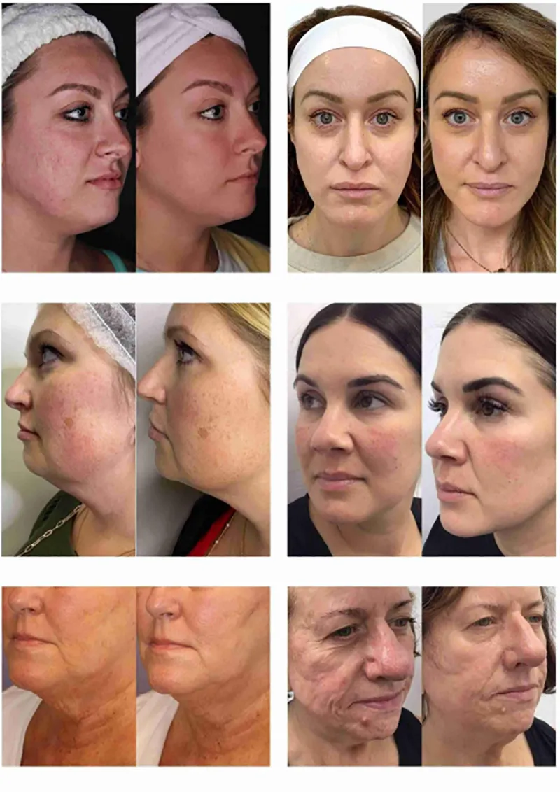 Morpheus8 Microneedling RF Micro Needle Radio Frequency Machine Acne ...