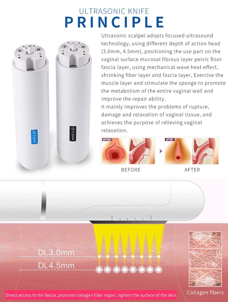 High Intensity Focused Ultrasound Machine for Vaginal Tightening with 3 ...