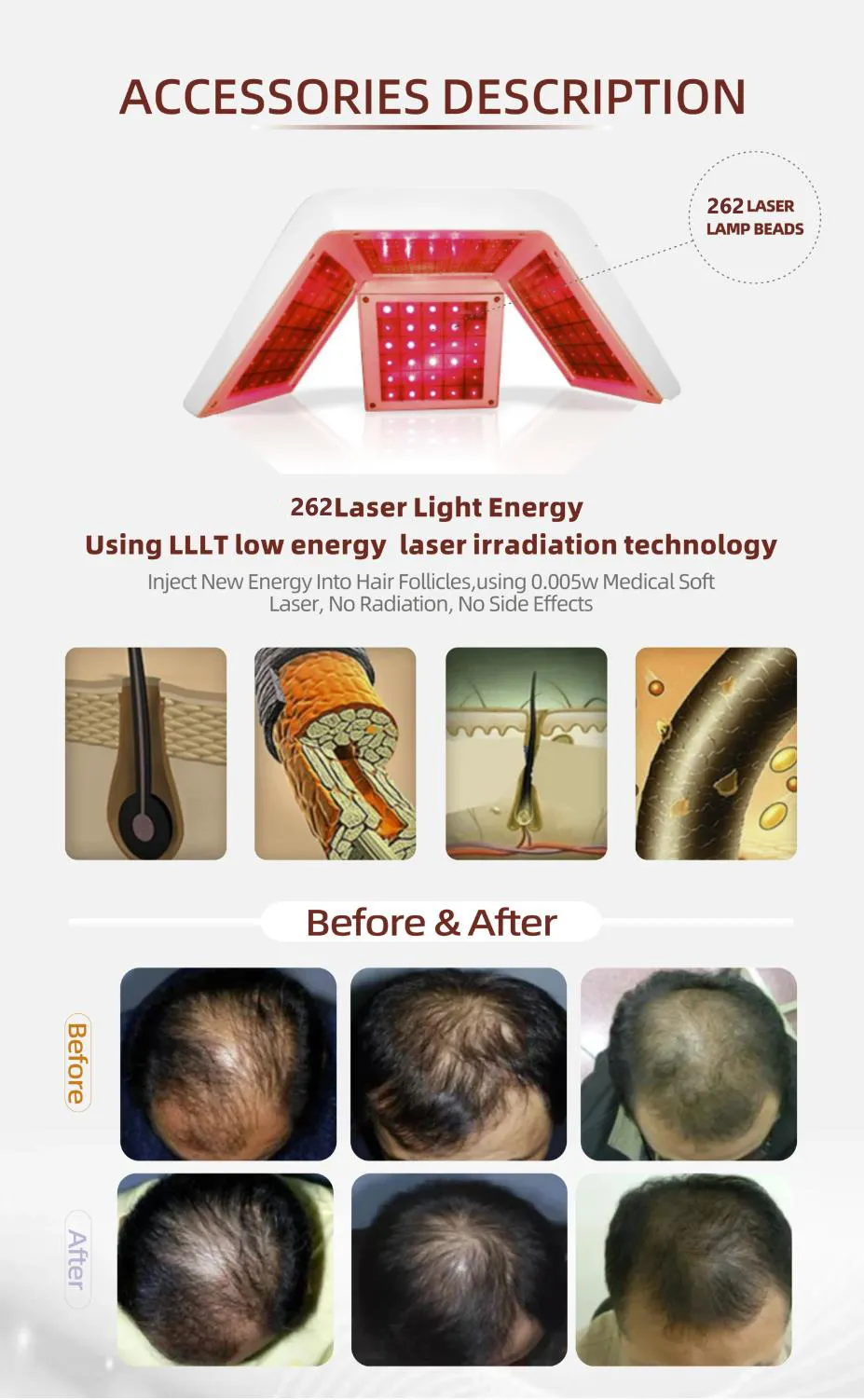 Professional Laser Hair Regrowth System - 650nm Diode Therapy, Hair ...