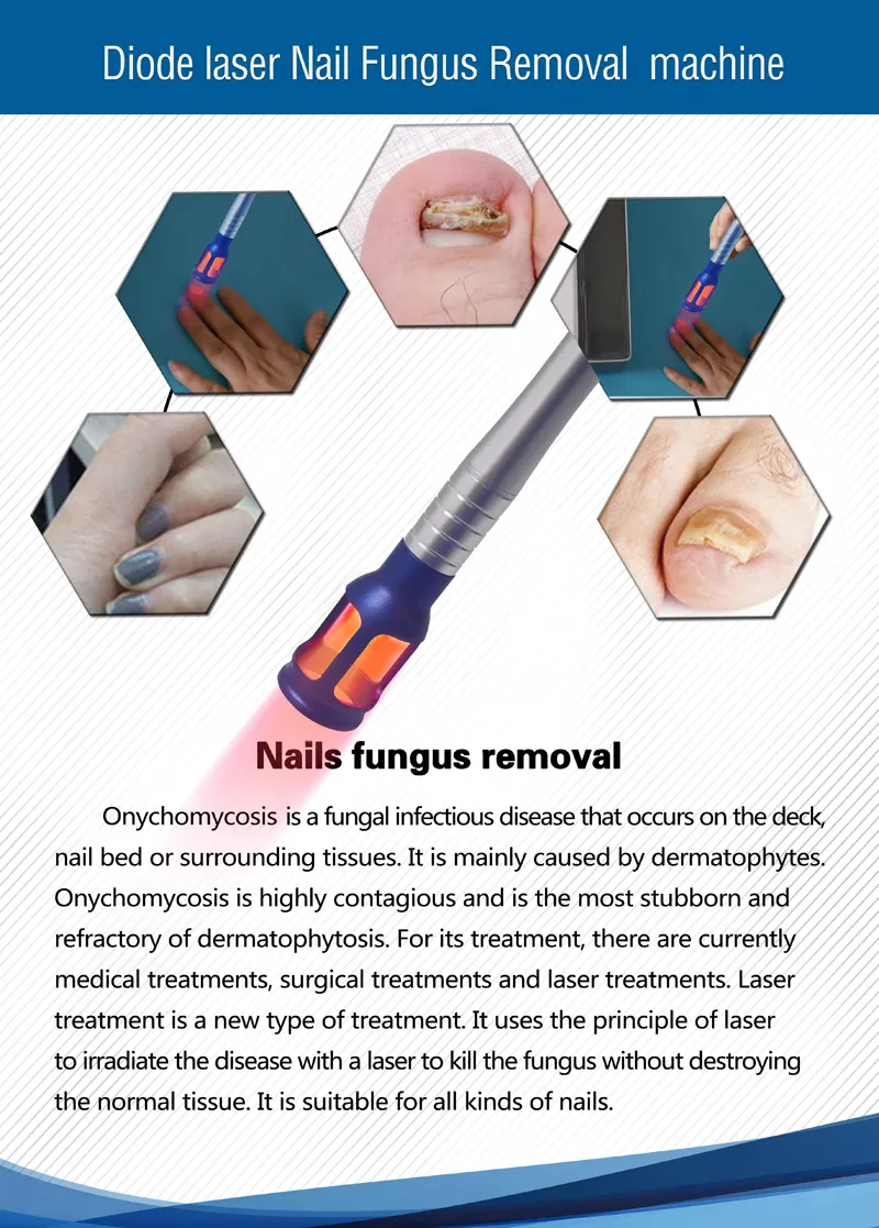 Onychomycosis Toenail Fungus Remover 980nm Laser Machine Spa, Salon ...