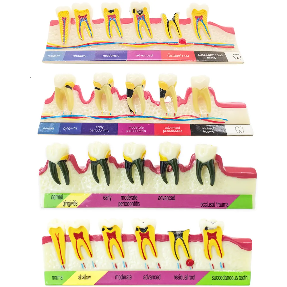 DHgate.com:Periodontal Disease Model with 23 Teeth - Dental Caries ...