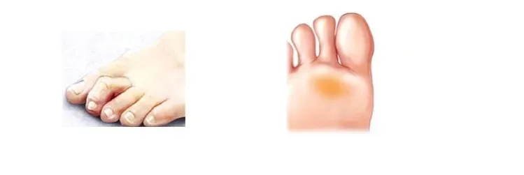 Feet Care Hallux Valgus Orthopedic Metatarsal Crooked Overlapping ...