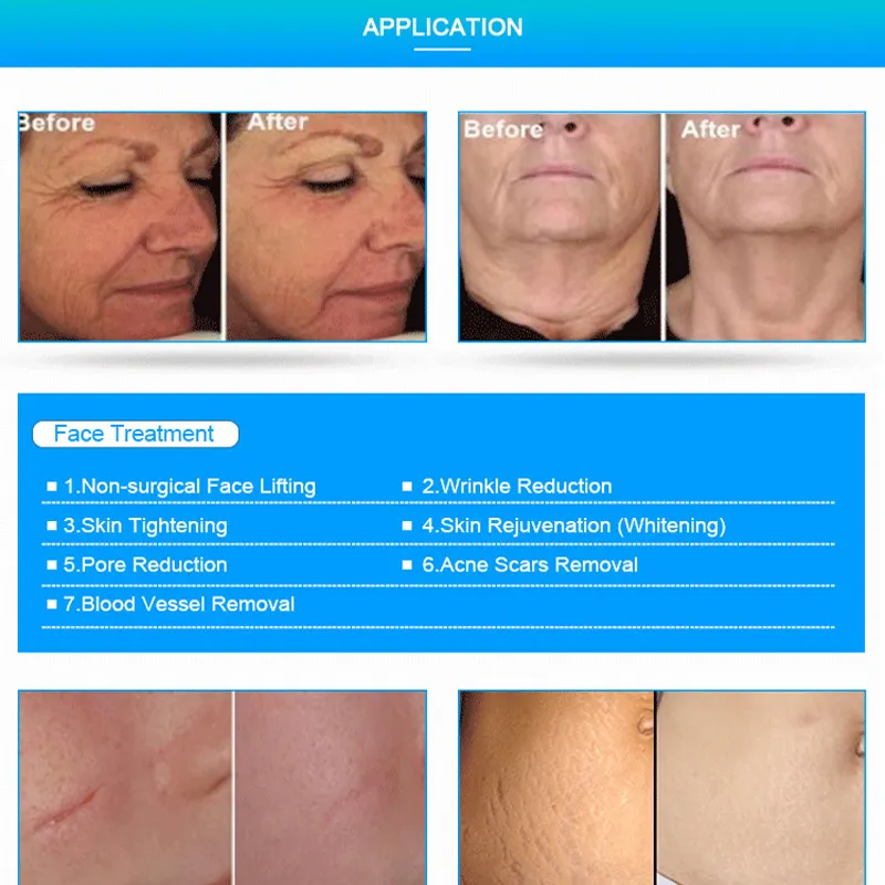 Fractional RF Micro Needling Microneedling Therapy: 10 Pin, 25 Pin, and ...