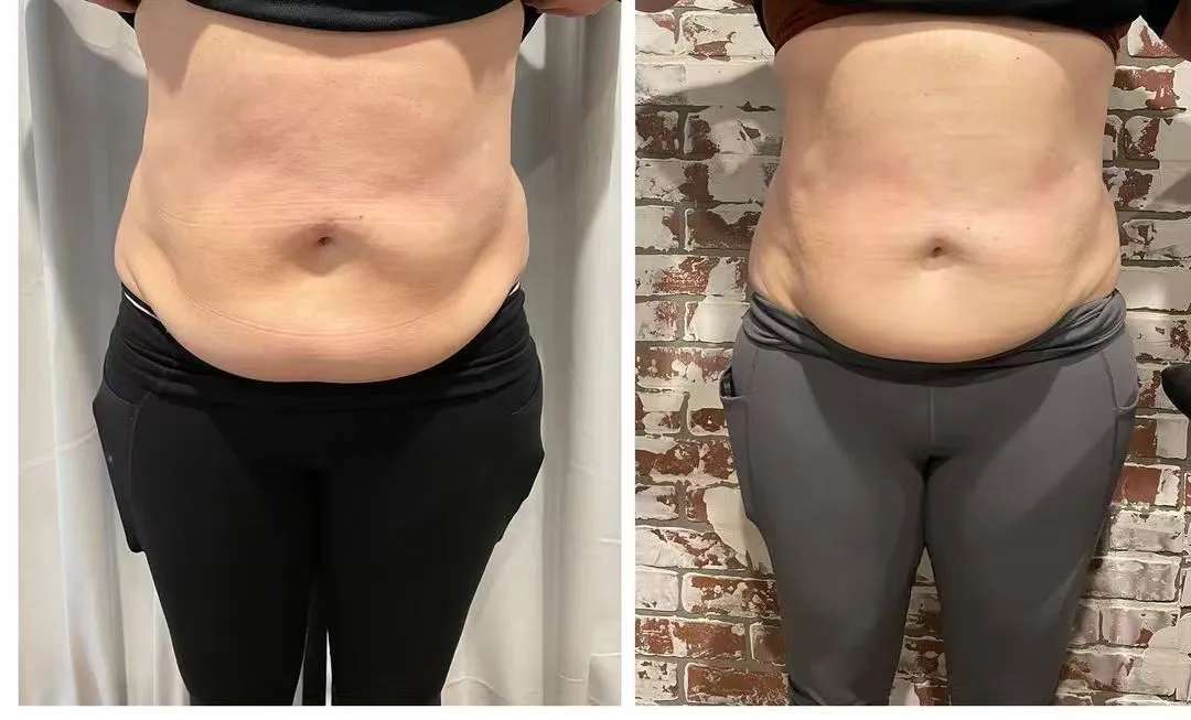 EMSzero Neo Machine with RF: Body Sculpting, Muscle Building, Fat ...