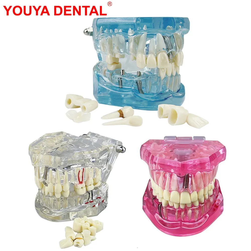 Dental Typodont Model With Removable Teeth: Standard Model For Dentist ...