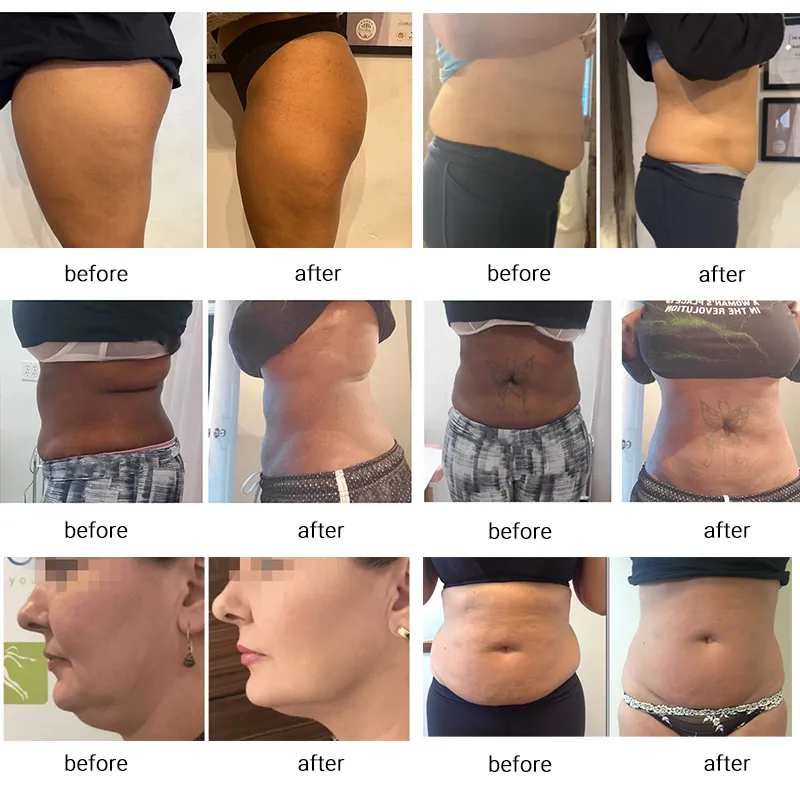 Trusculpt iD 3D Flex Monopolar RF body contouring fat Trusculpt iD 3D Flex Monopolar RF body contouring fat