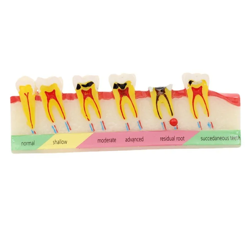 Anatomical Teeth Models: Periodontal Disease & Caries Breakdown Model ...
