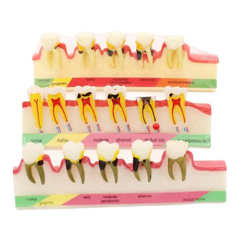 Anatomical Teeth Models: Periodontal Disease & Caries Breakdown Model ...