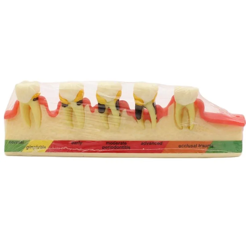 Anatomical Teeth Models: Periodontal Disease & Caries Breakdown Model ...