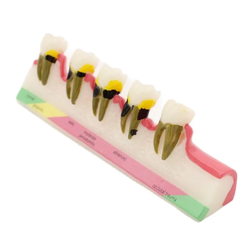 Anatomical Teeth Models: Periodontal Disease & Caries Breakdown Model ...