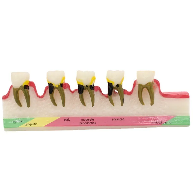 Anatomical Teeth Models: Periodontal Disease & Caries Breakdown Model ...