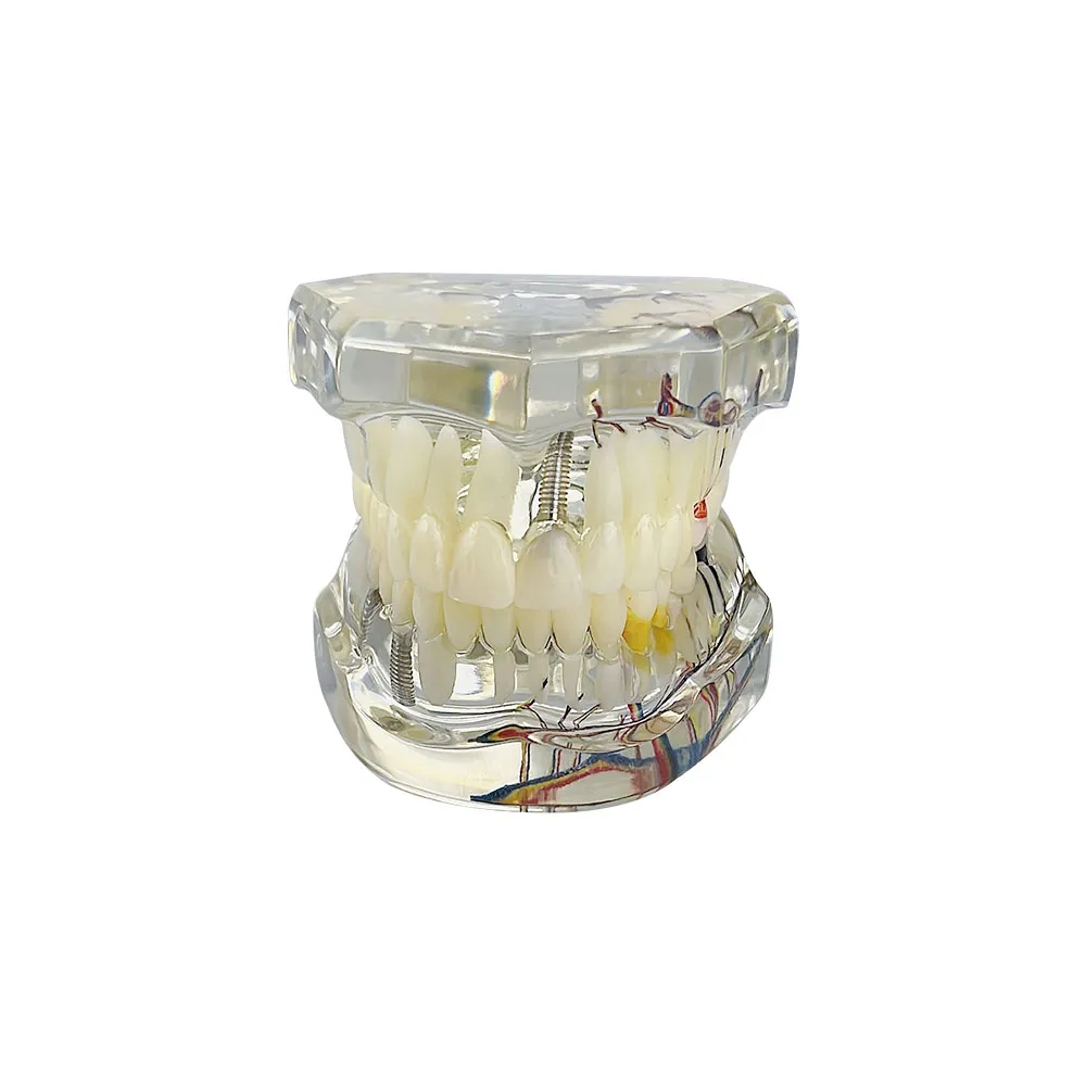 Anatomical Teeth Models: Deciduous & Permanent Tooth Pathological Model ...