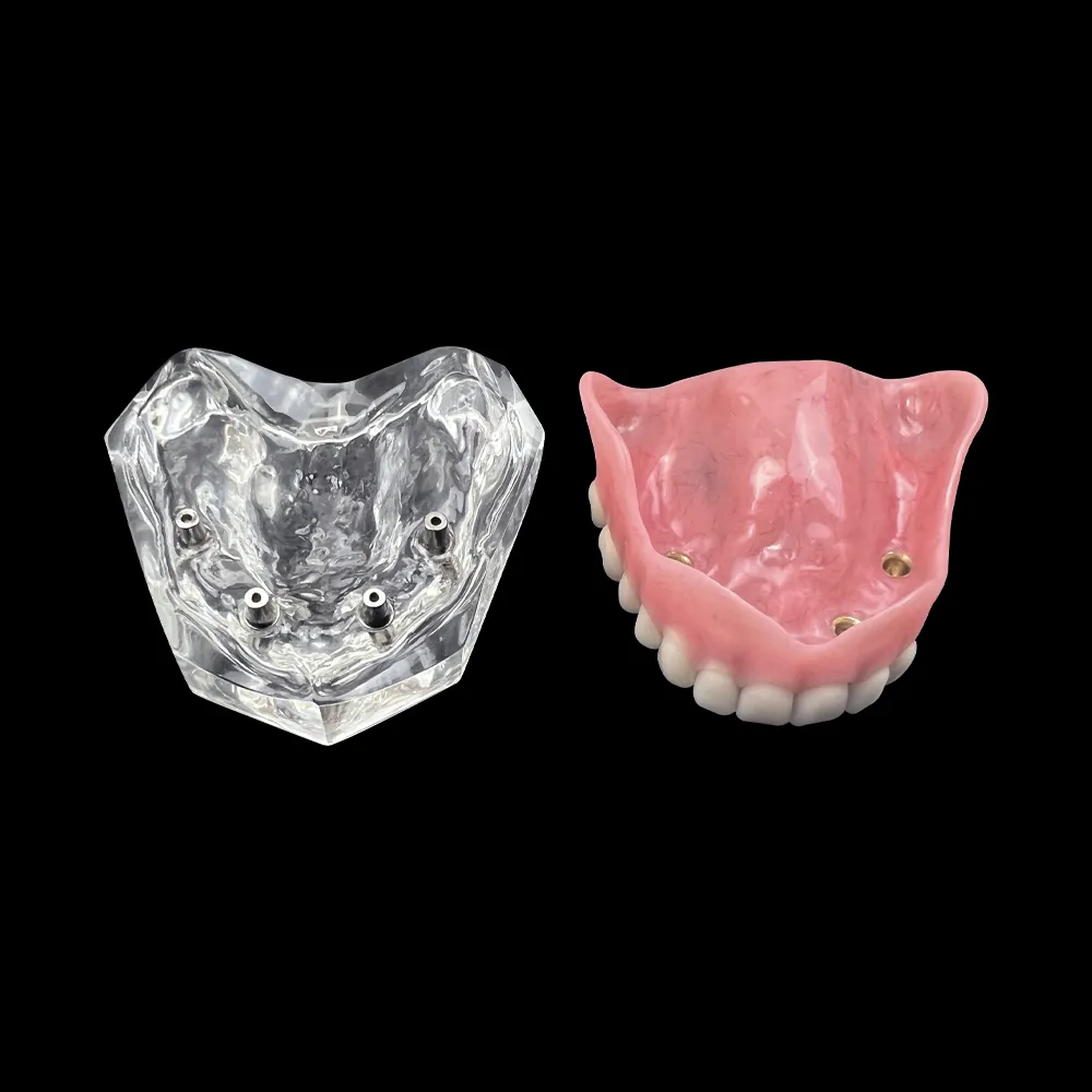 Dental Mandibular Maxillary Transparent Teeth Model With 4 Implants For ...