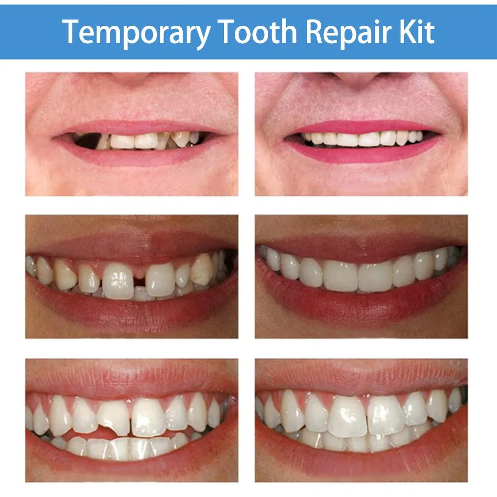 Temporary Tooth Repair Kit Denture Adhesive Glue For Teeth And Gaps ...