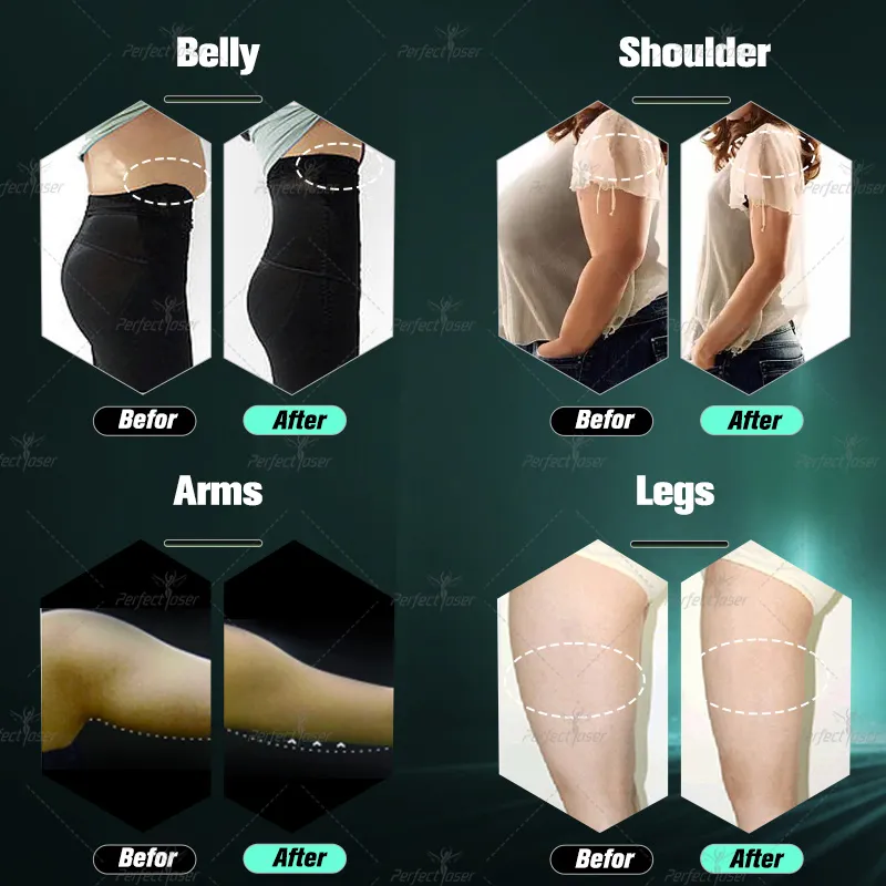 Lipolaser Machine For Salon Use: Cold Dual Laser Body Shaping, Slimming ...