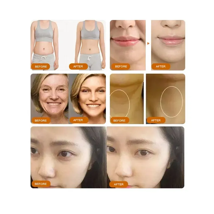 Beauty Items Portable 3D Hifu SMAS Lifting HIFU Machine Face Lifting ...
