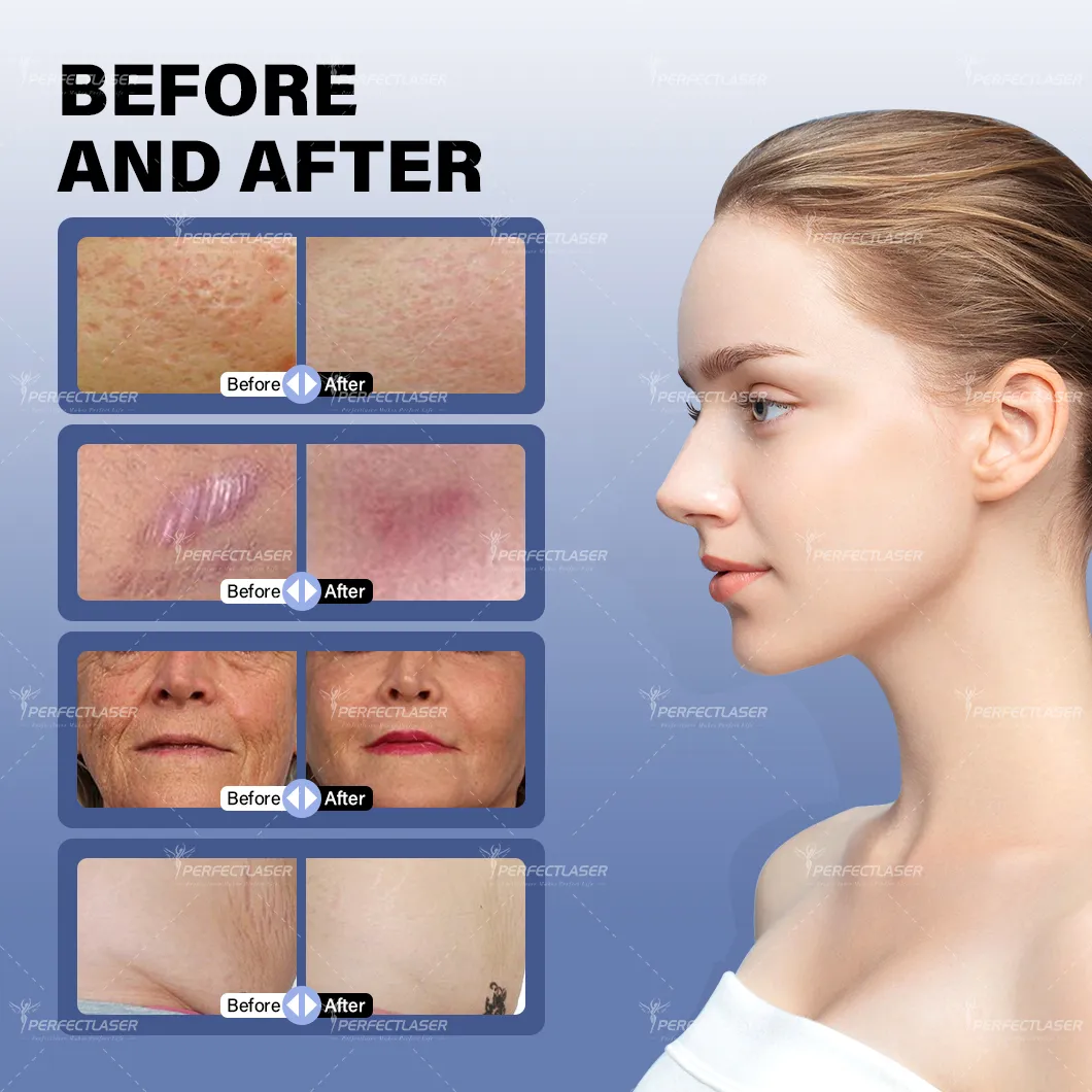 Fractional Co2 Machine Warts Precise Targeting 20 20mm Focus Spot Laser ...